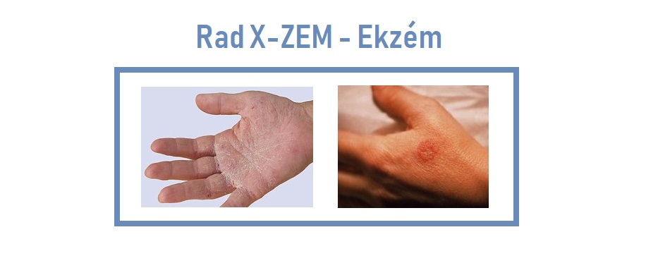 X-ZEM EKZÉM - www.ahava.sk